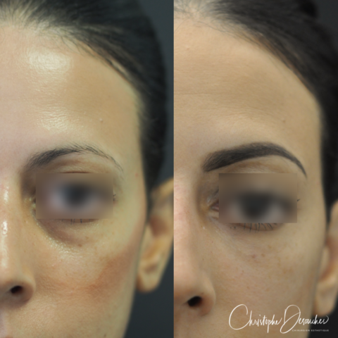 Chirurgie esthétique pour cernes creux à Marseille - Docteur Christophe ...